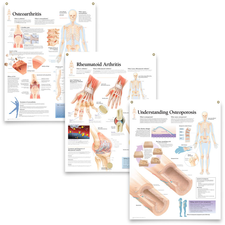 Trinx Set Of 3 Framed Medical Posters: Osteoarthritis Rheumatoid ...
