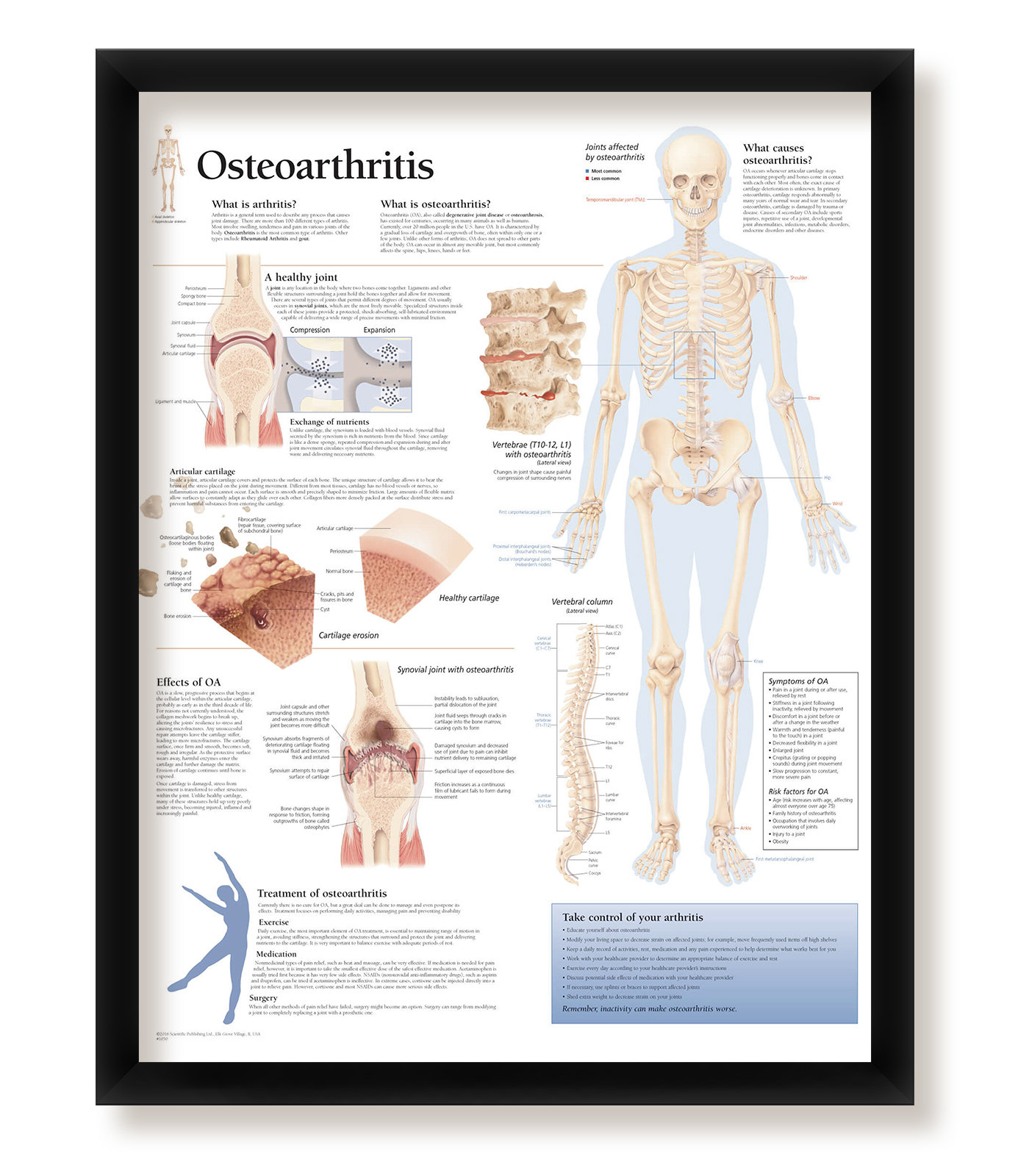 Trinx Jasmeh Framed Medical Poster Osteoarthritis 22"X28" Wall Diagram ...