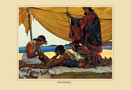 Buyenlarge 'Trephining' by Robert Thom Graphic Art | Wayfair