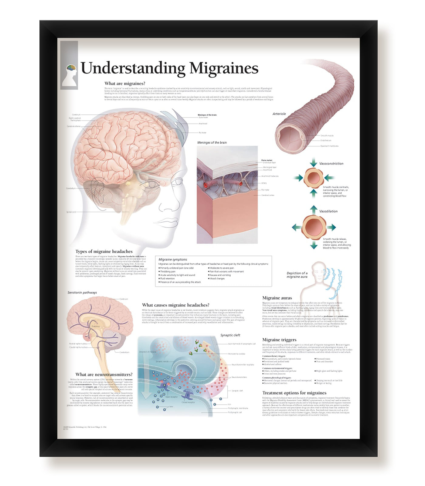 Trinx Jasminda Understanding Migraines Framed Medical Educational ...