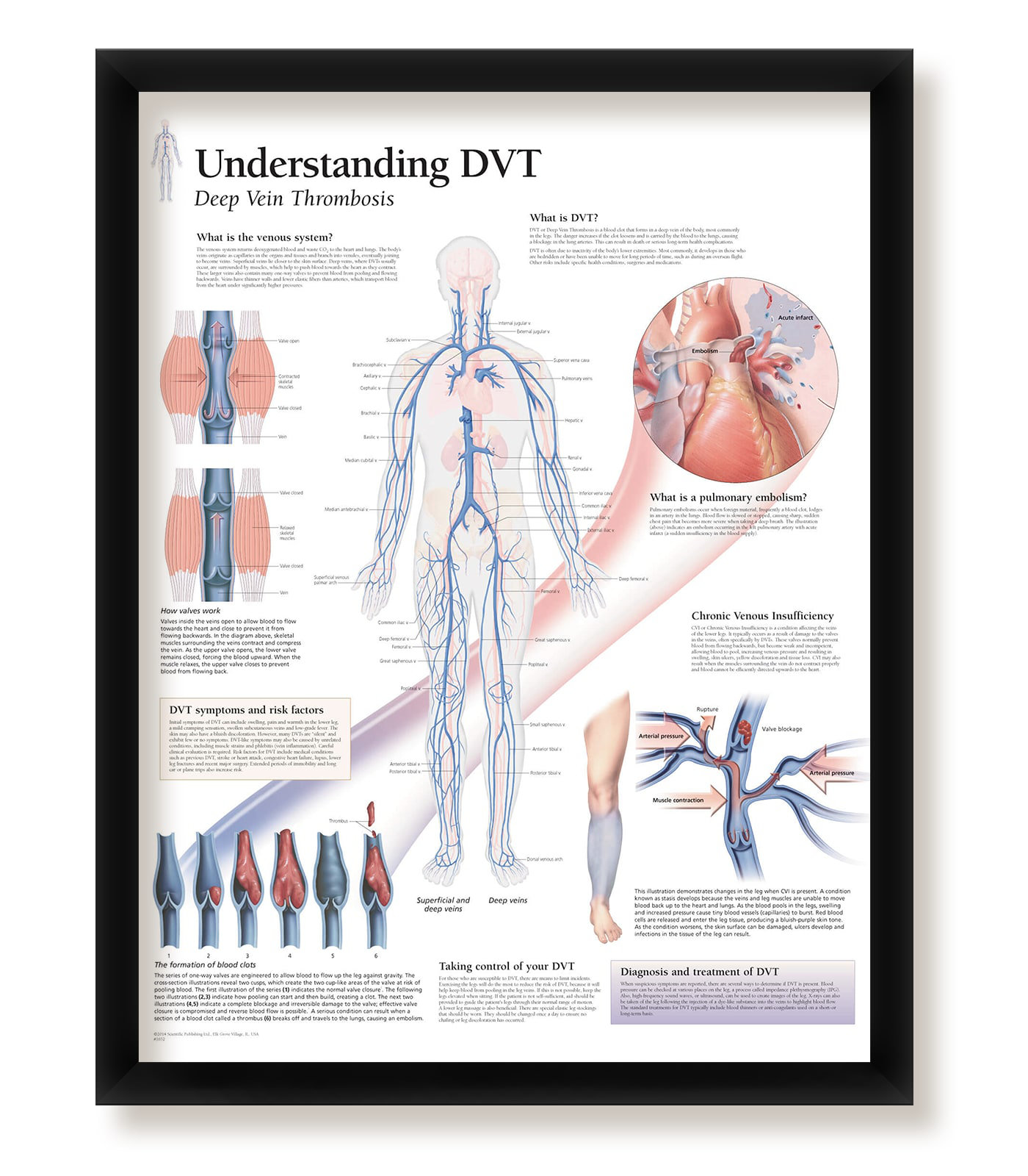 Trinx Jatavis Understanding DVT Deep Vein Thrombosis Framed Medical ...